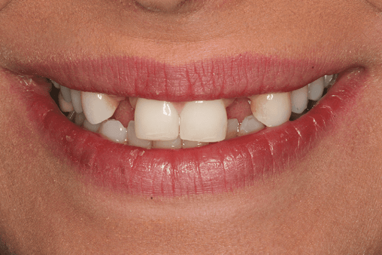 Replacing Missing Front Teeth with Implants - PureCare Dental
