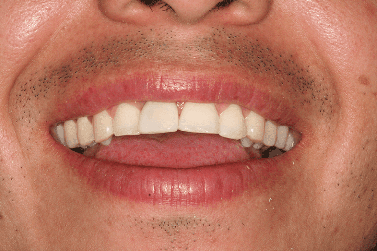 Replacing a Non-Savable Front Tooth with an Implant - PureCare Dental