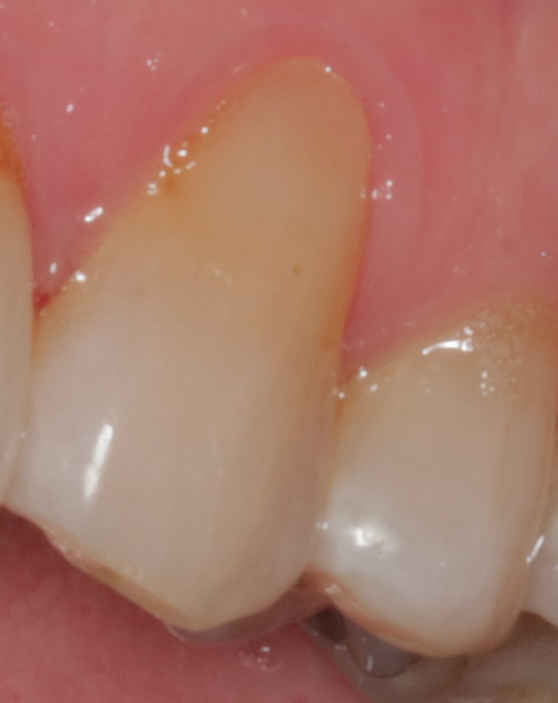 Removal of Notches on the Gum Line - PureCare Dental