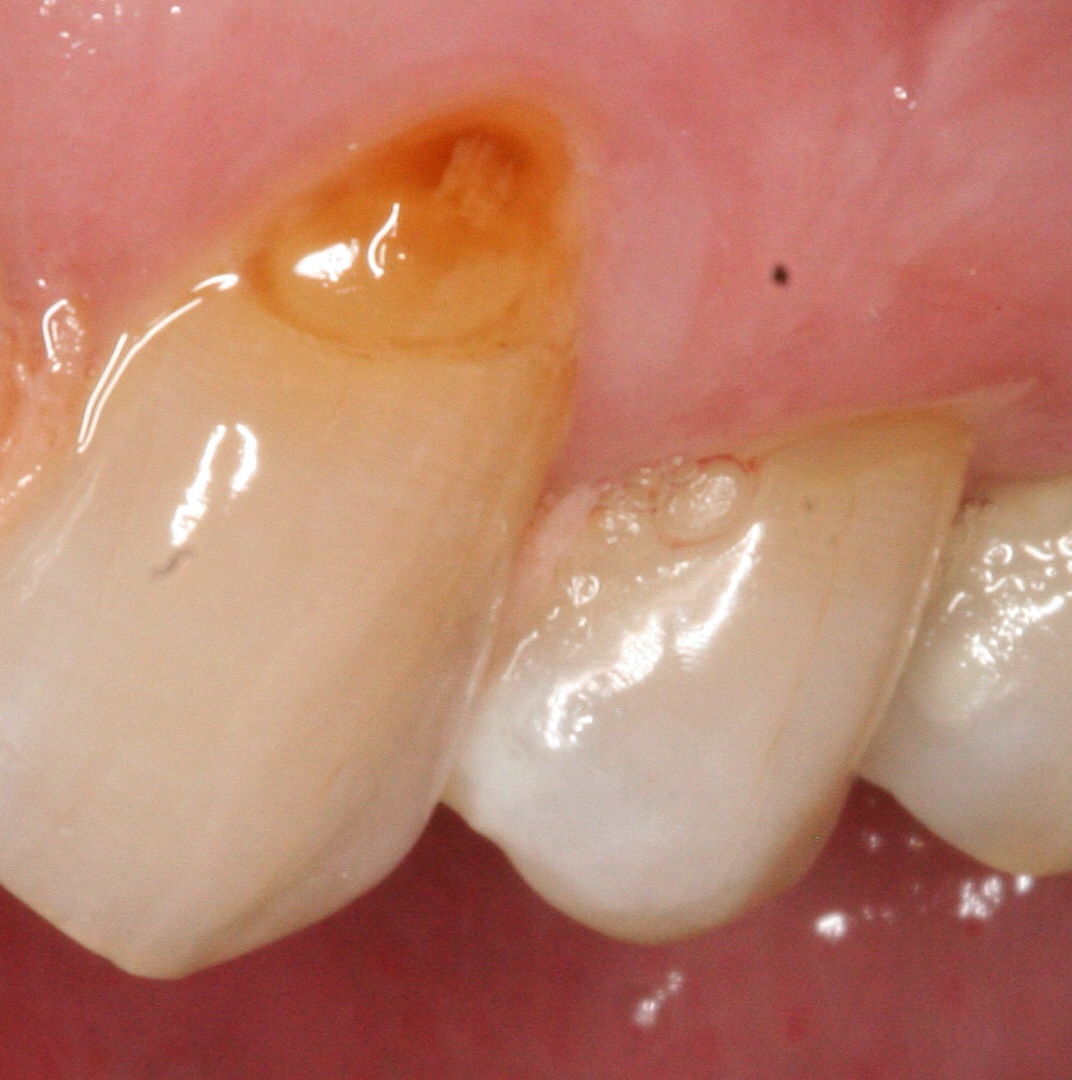 Removal of Notches on the Gum Line - PureCare Dental