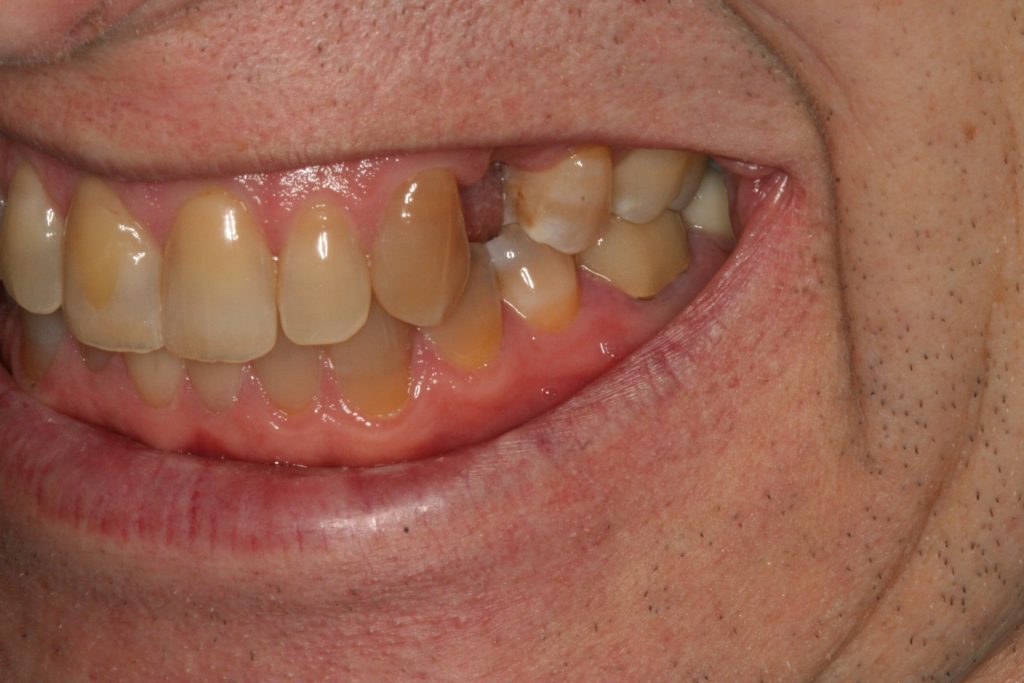 Replacing a Missing Bicuspid - PureCare Dental