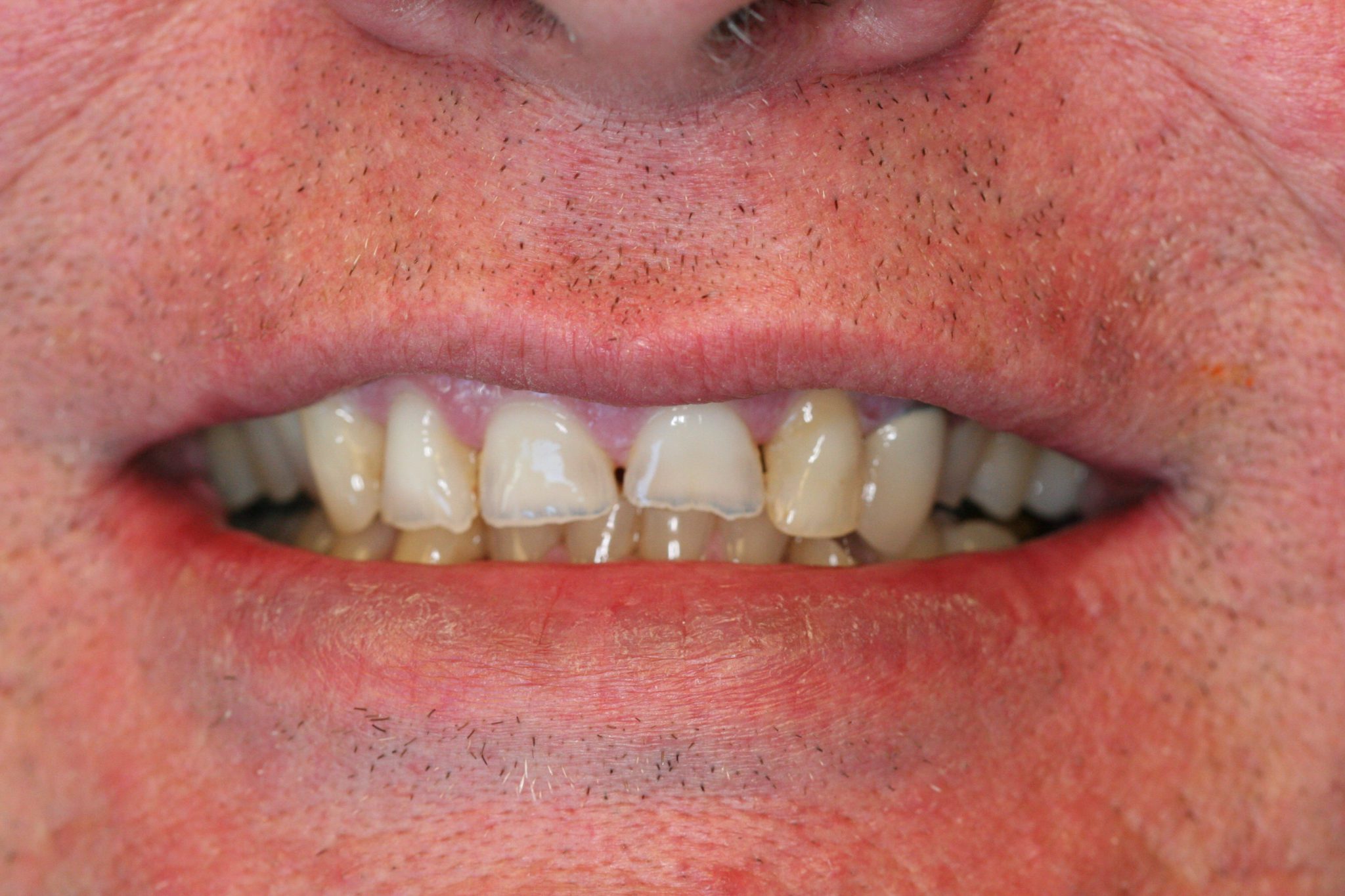 Taller, Youthful New Front Teeth - PureCare Dental